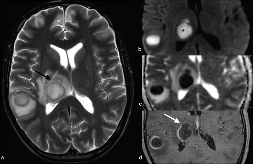 Cerebral abscesses imaging: A practical approach