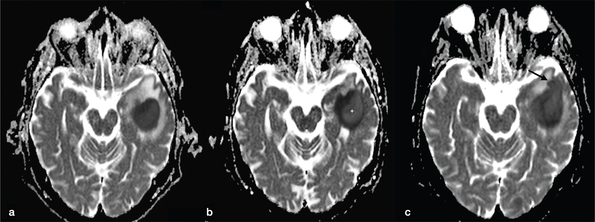 Cerebral abscesses imaging: A practical approach