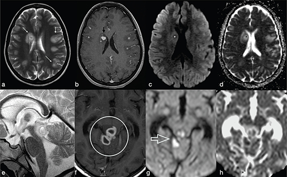 Cerebral abscesses imaging: A practical approach